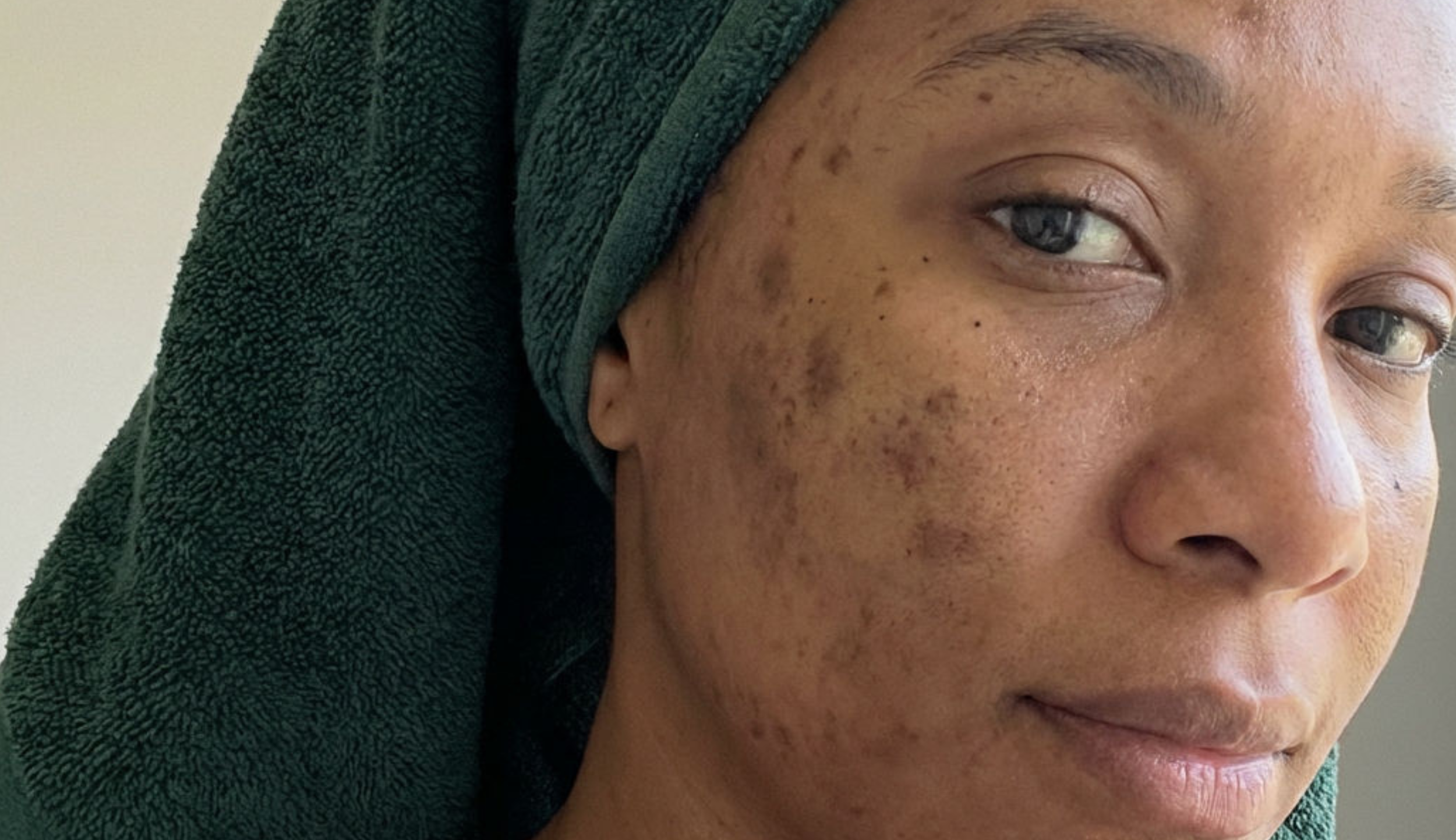 How to Clear Dark Spots on Skin? – Glean Qasil