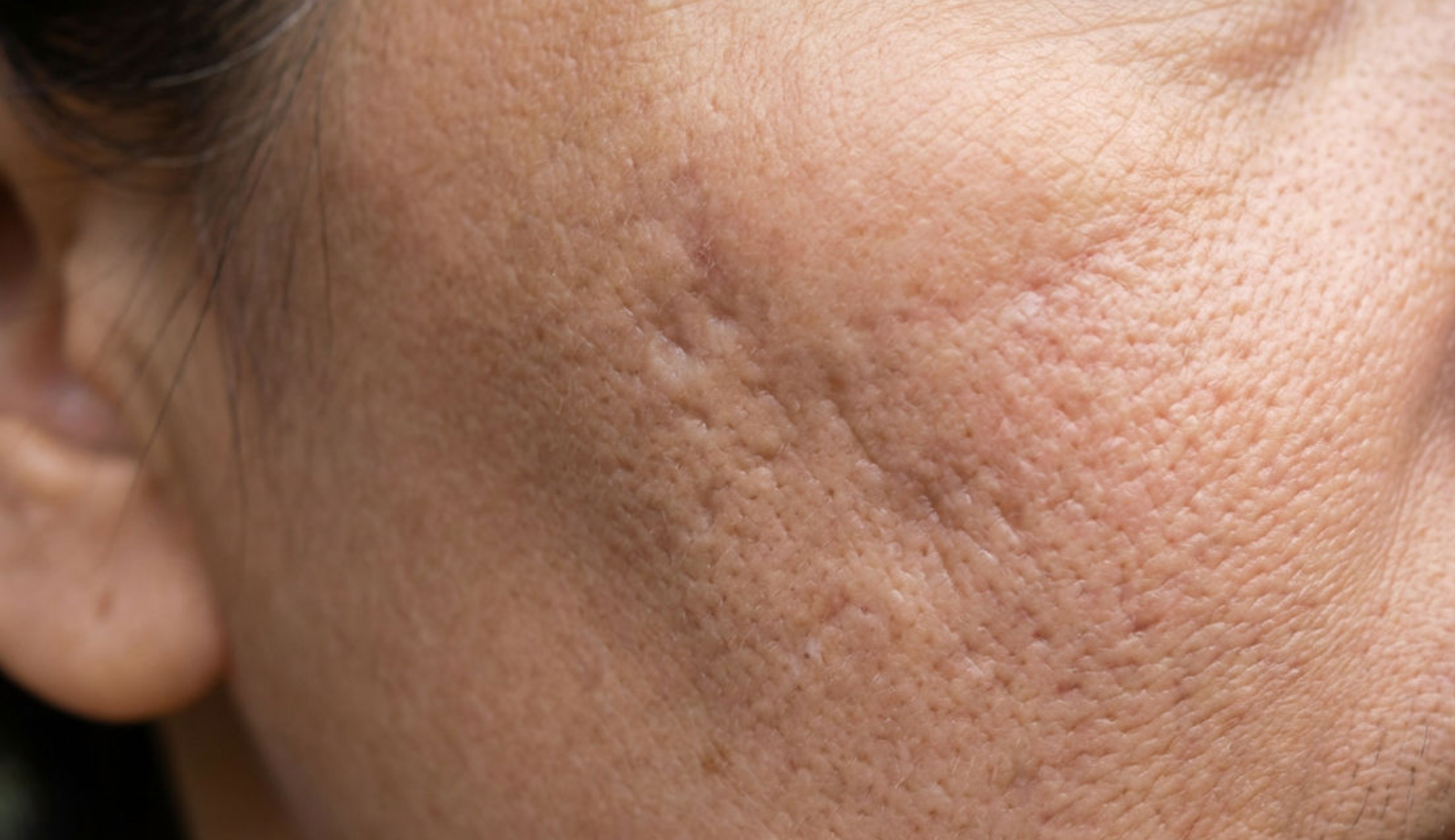 How to Get Rid of Craters in Skin Naturally? – Glean Qasil